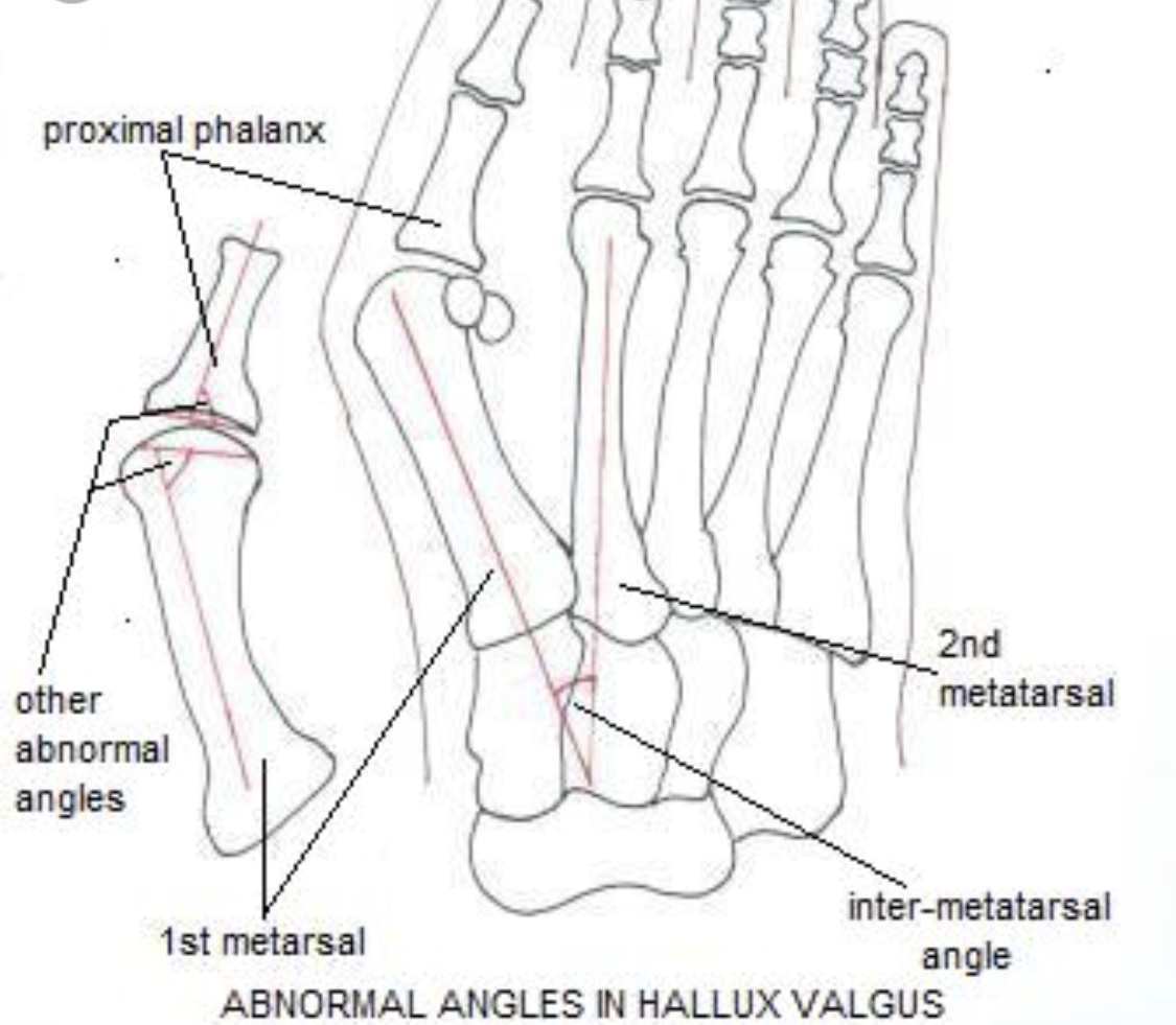 Hammertoes - Professional Bunion Foot Treatment Doctor